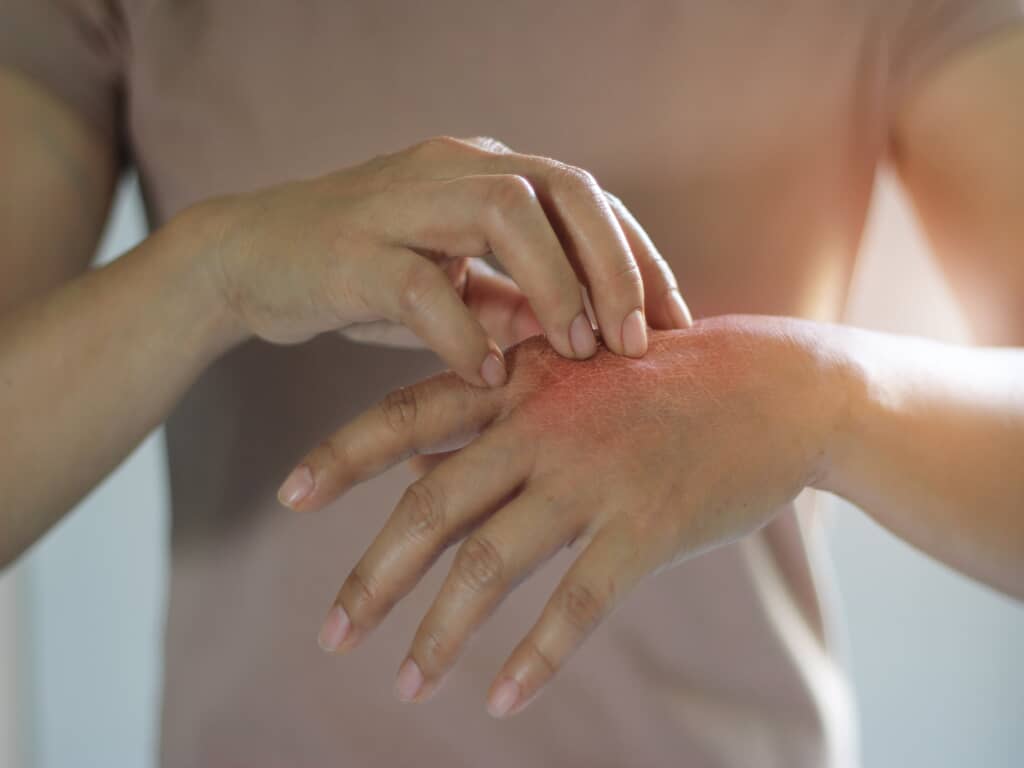 What Are First, Second, and Third Degree Burns?